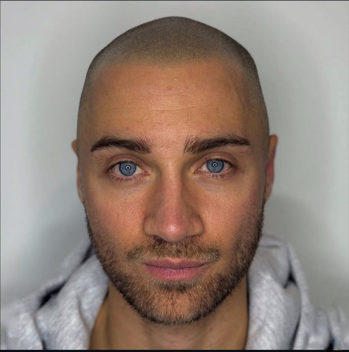 Portfolio Scalp Micropigmentation